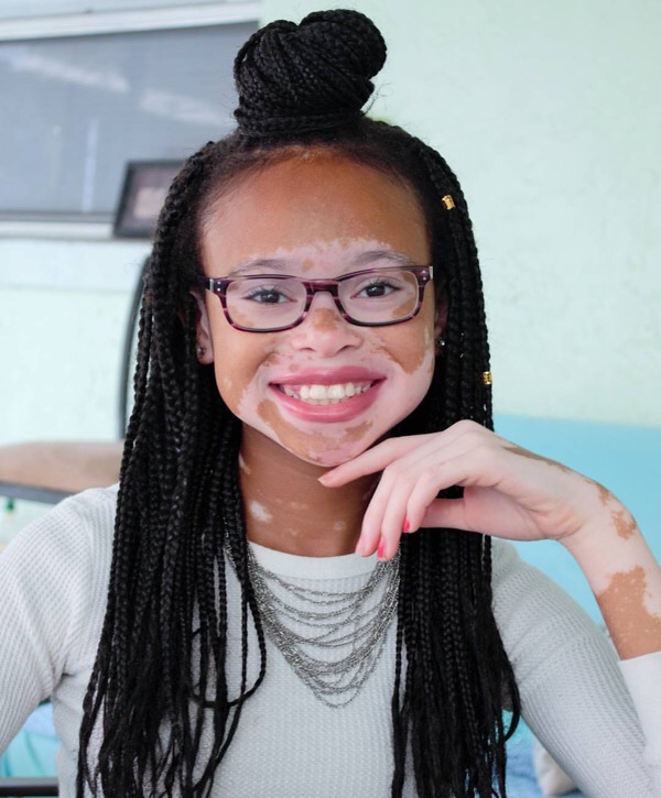 10yearold With Vitiligo Becomes An Instagram Star